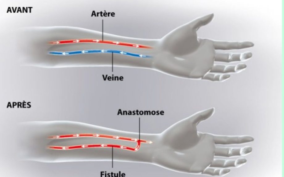 Quels Sont Les Symptômes D’Une Fistule Périlymphatique – OVNI