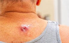 Traitement Naturel du Kyste Pilonidal : Découvrez les Meilleures ...