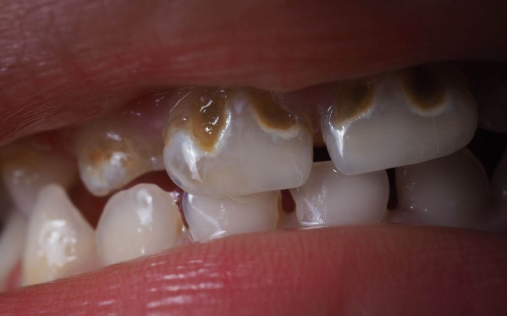Les dents pourries : origines, conséquences et solutions - STCCCV